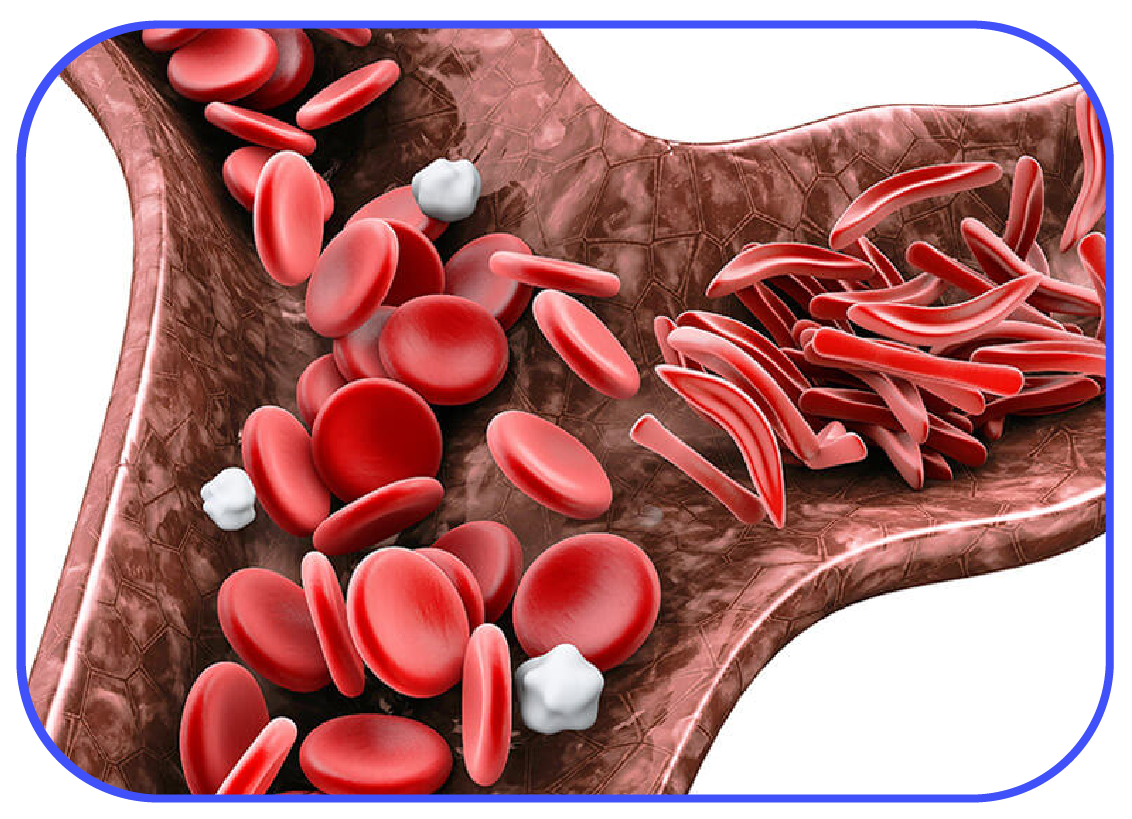Anemia falciforme y su impacto en la población colombiana - ANNAR ...