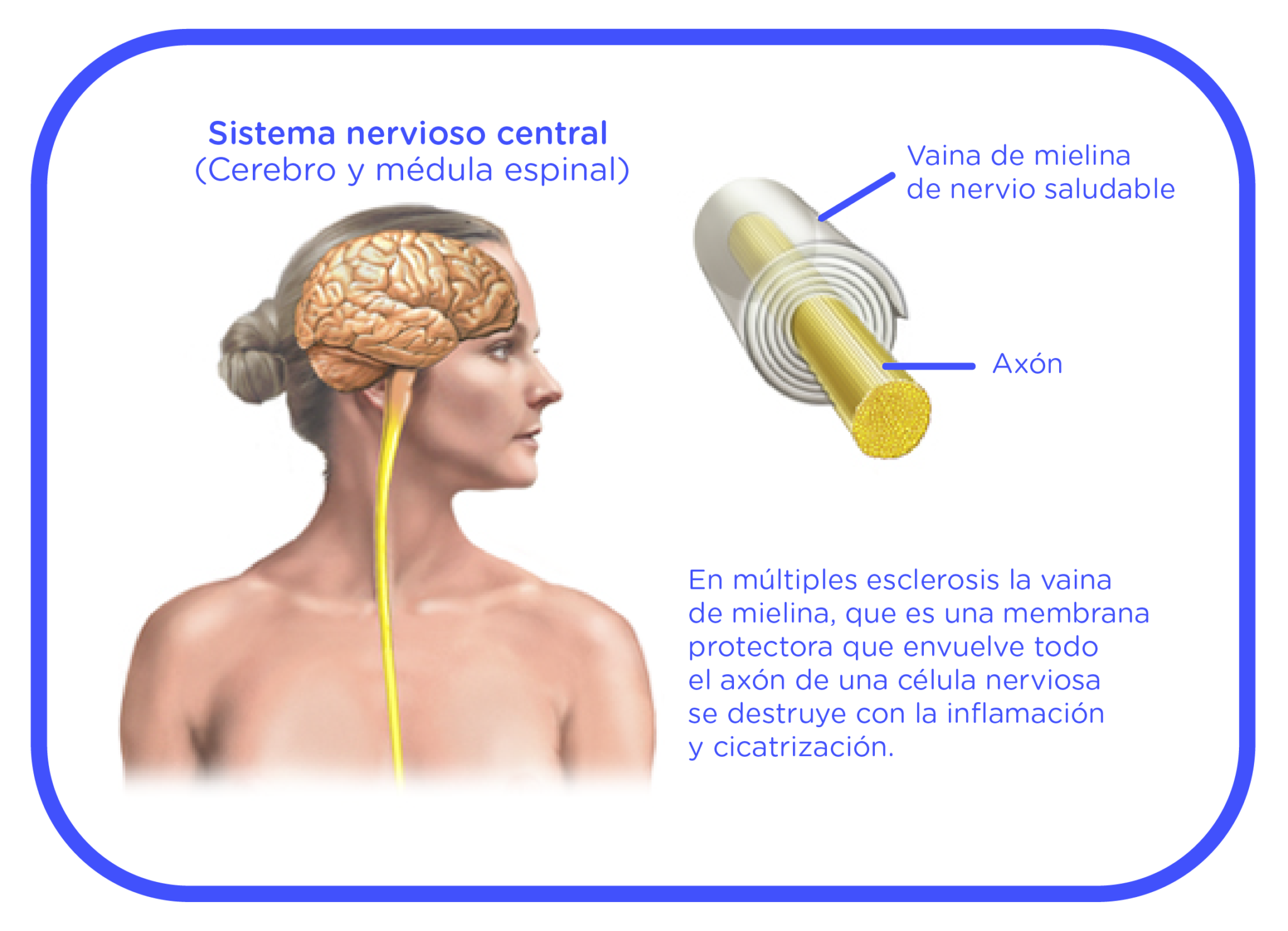 ¿Sabes qué es la esclerosis múltiple? - ANNAR Health Technologies ...